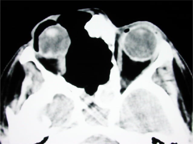 Exenteration of the Orbit - orbital surgery | PPT