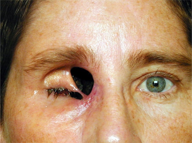 Exenteration of the Orbit - orbital surgery | PPT