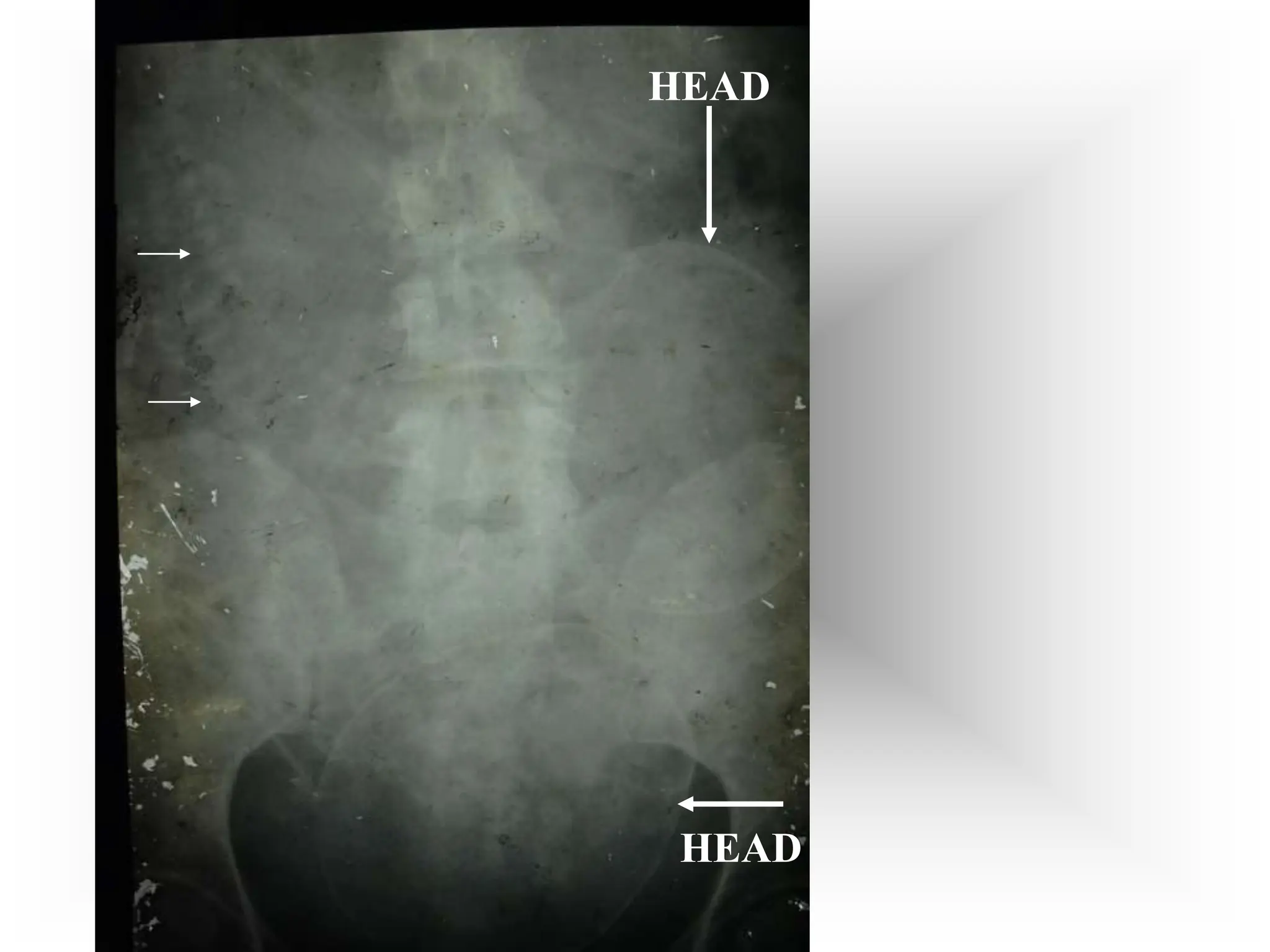 pratical Forensic medicine Exercise-X-Rays.ppt