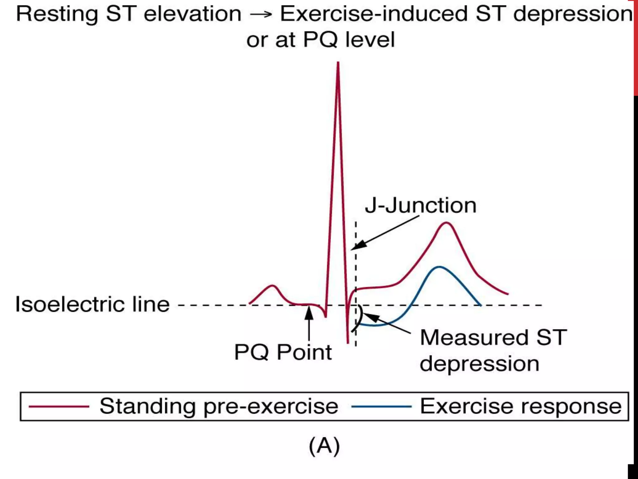Exercise ecg | PPTX