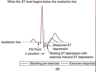 Exercise ecg | PPTX