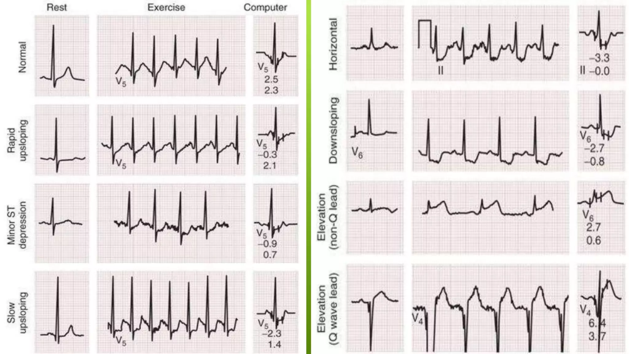 Exercise electrocardiography | PPTX