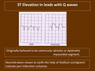 EXERCISE INDUCED ST ELEVATION _ | PPSX