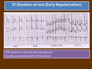 EXERCISE INDUCED ST ELEVATION _ | PPSX