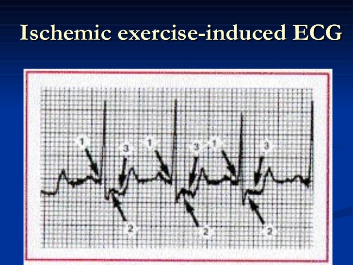 Exercise stress ecg. dmo