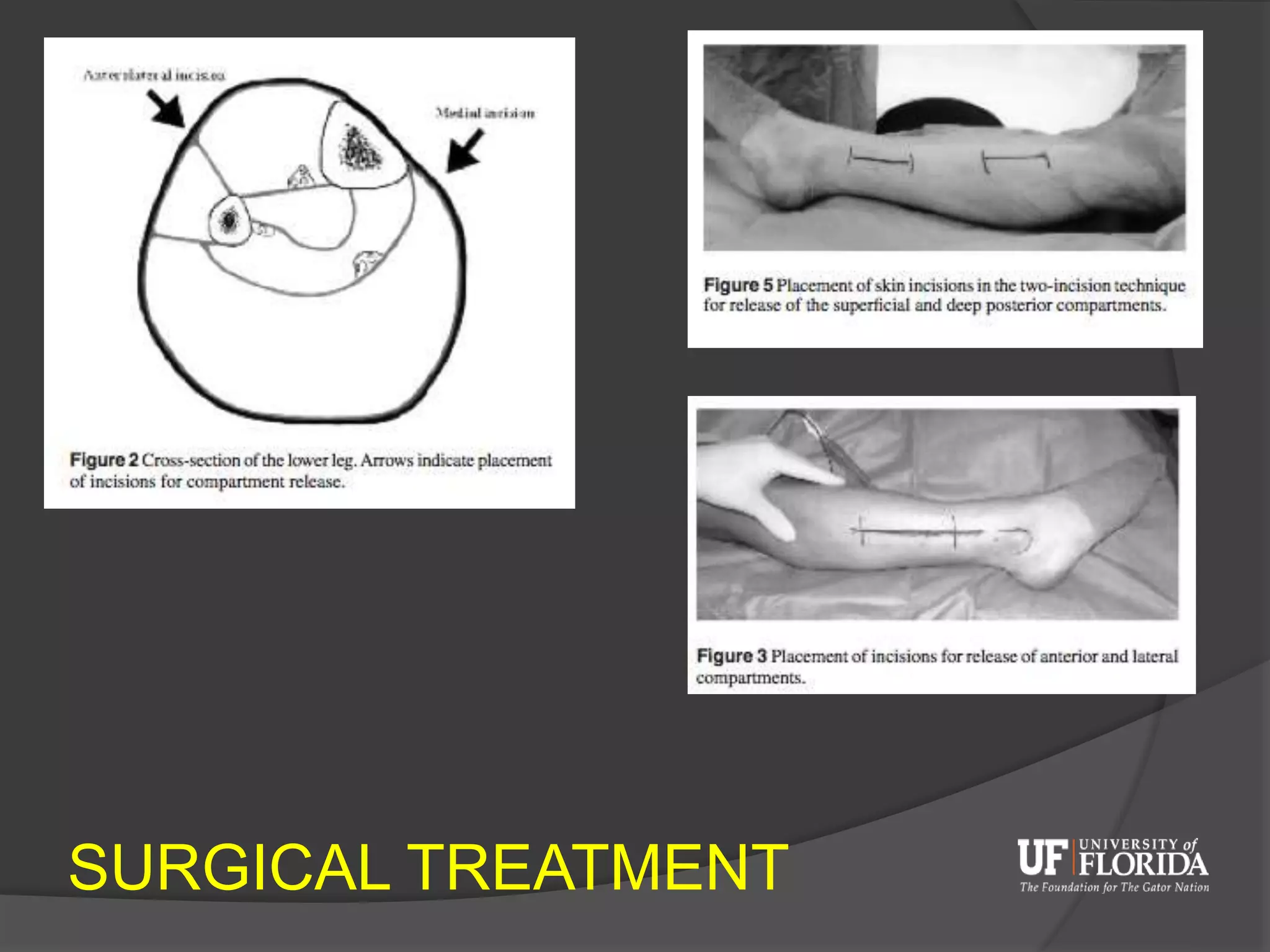Chronic Exertional Compartment Syndrome (University of Florida) | PPTX | Death, Injury, or ...