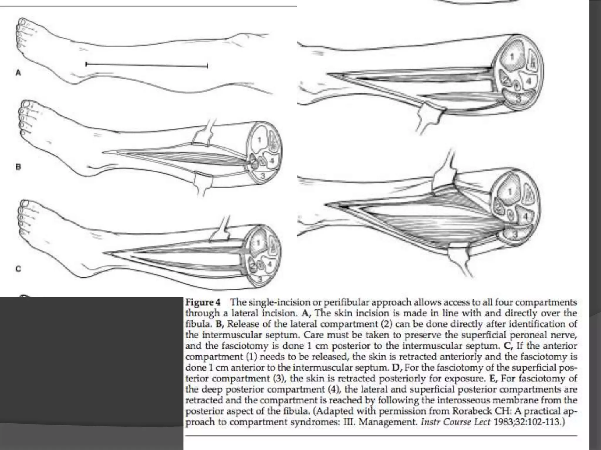 Chronic Exertional Compartment Syndrome (University of Florida) | PPTX