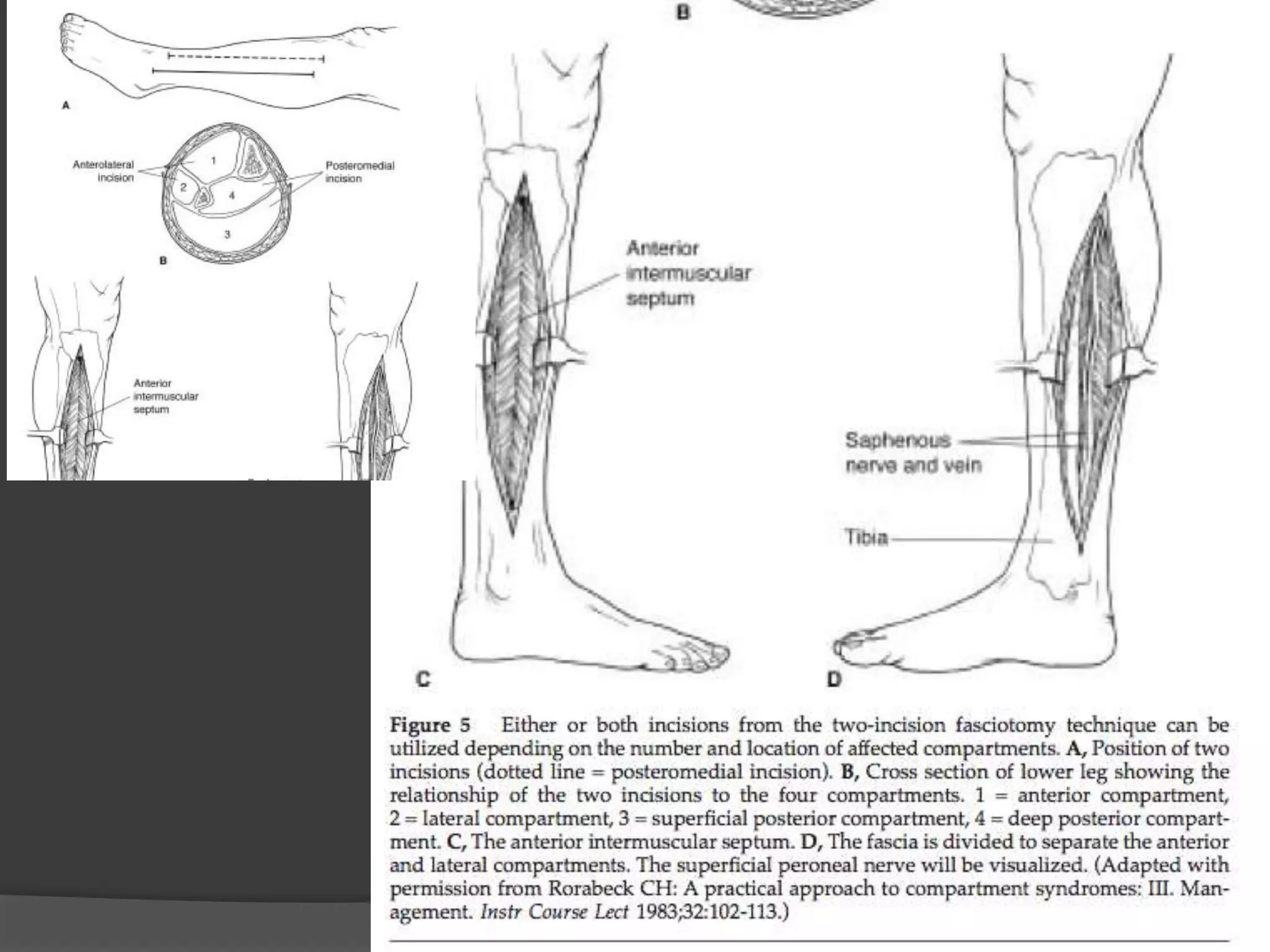 Chronic Exertional Compartment Syndrome (University of Florida) | PPTX | Death, Injury, or ...