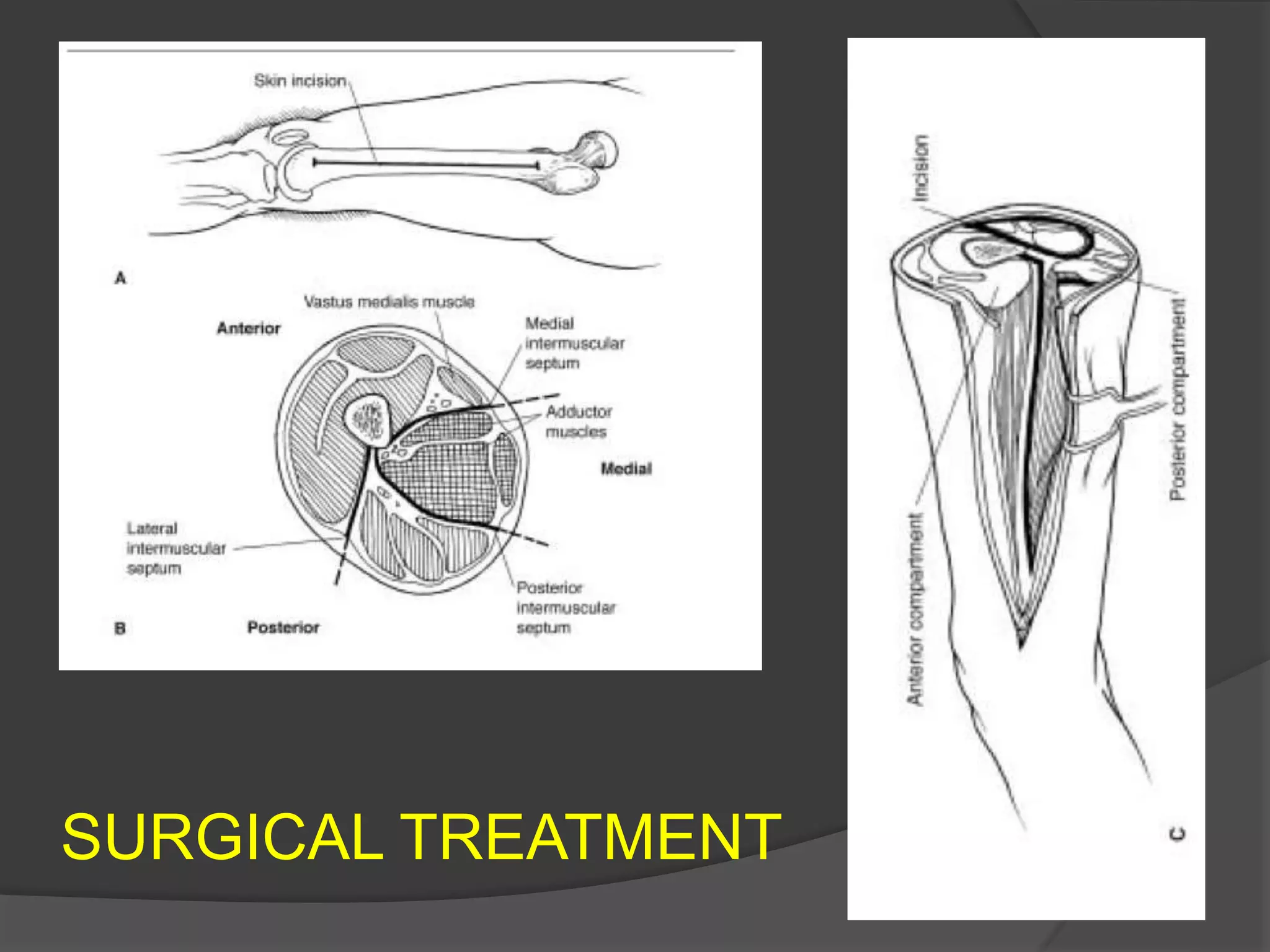 Chronic Exertional Compartment Syndrome (University of Florida) | PPTX | Death, Injury, or ...
