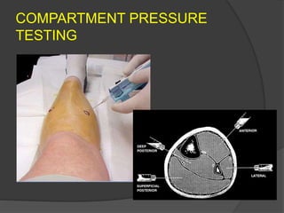 Chronic Exertional Compartment Syndrome (University of Florida) | PPTX