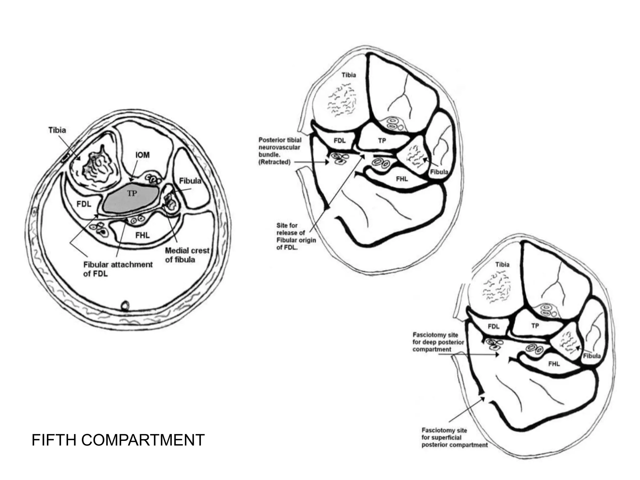 Chronic Exertional Compartment Syndrome (Henry Ford Health System) | PPTX | Death, Injury, or ...