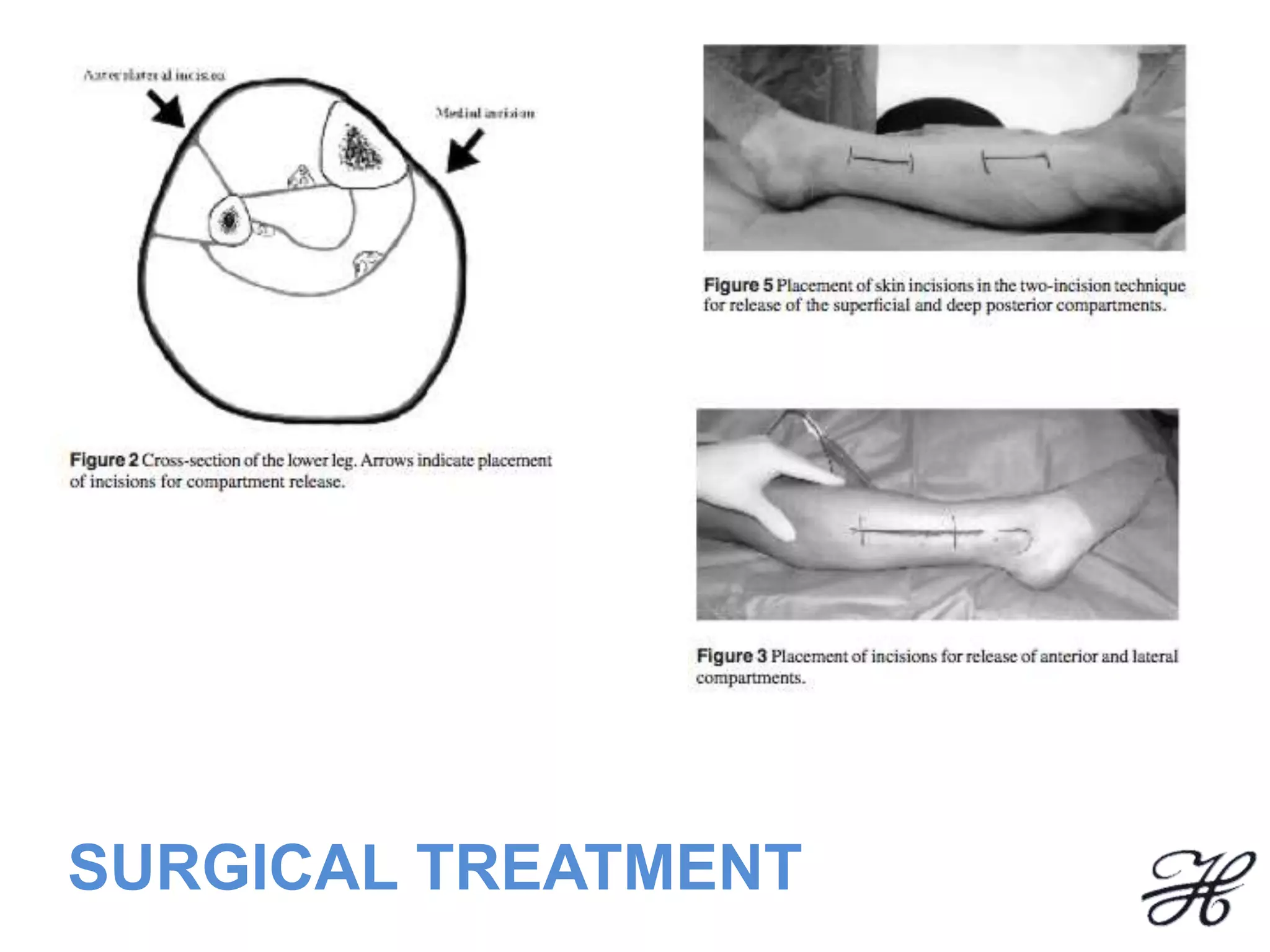 Chronic Exertional Compartment Syndrome (Henry Ford Health System) | PPTX | Death, Injury, or ...
