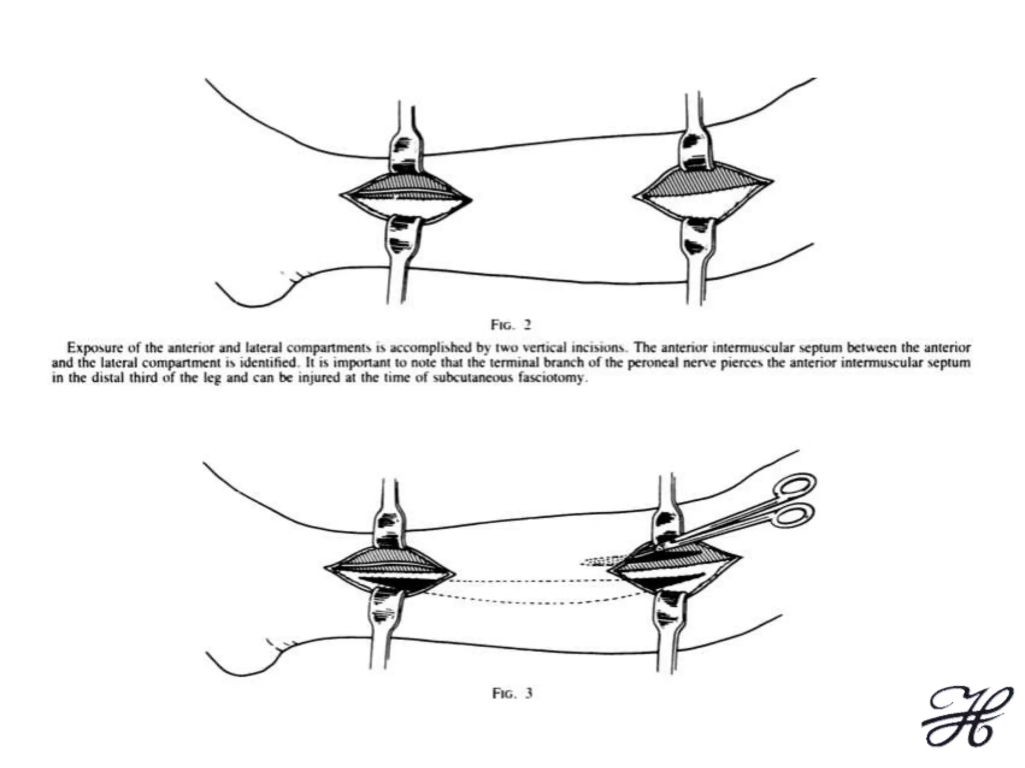 Chronic Exertional Compartment Syndrome (Henry Ford Health System) | PPTX | Death, Injury, or ...
