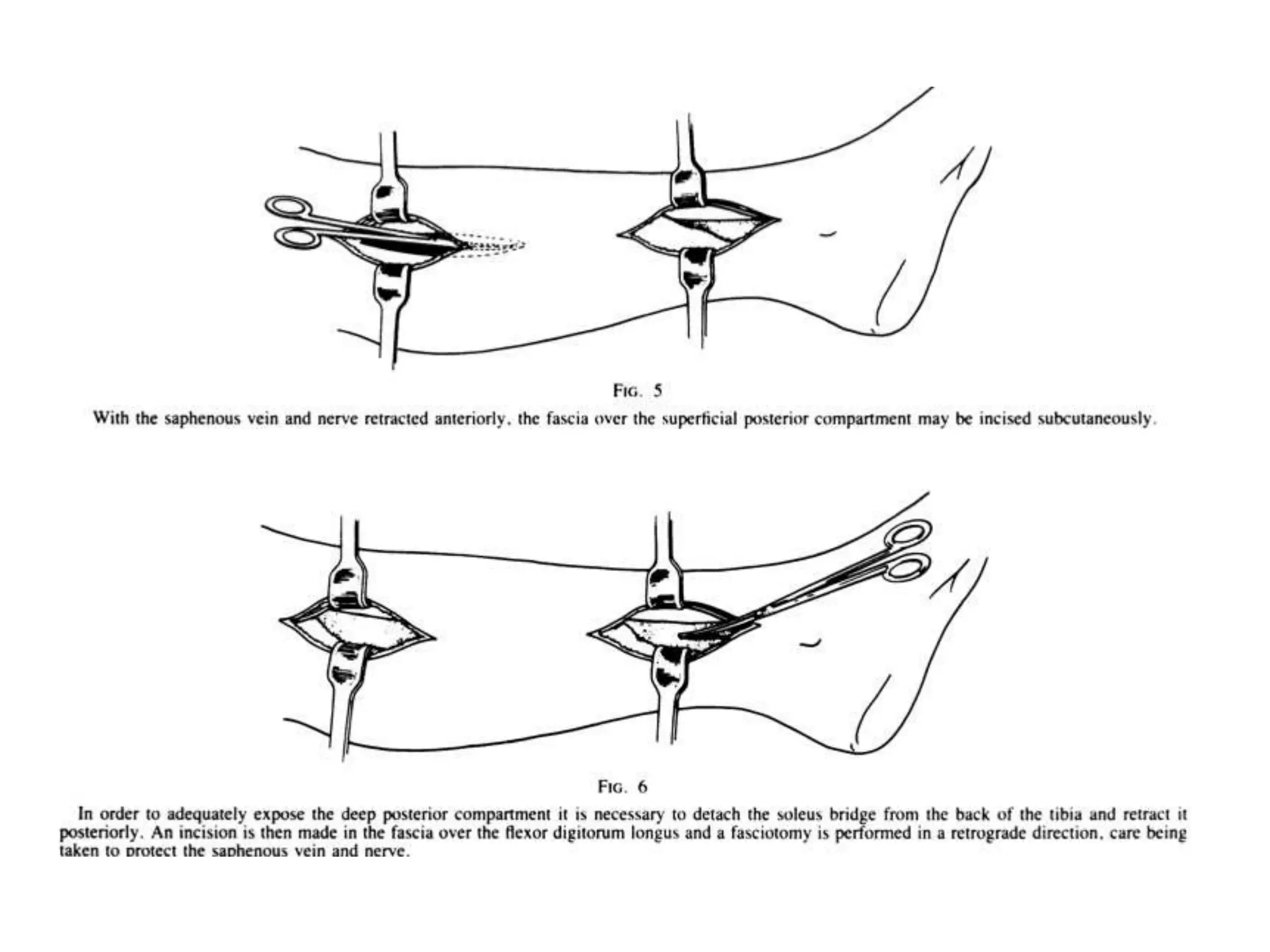 Chronic Exertional Compartment Syndrome (Henry Ford Health System) | PPTX | Death, Injury, or ...