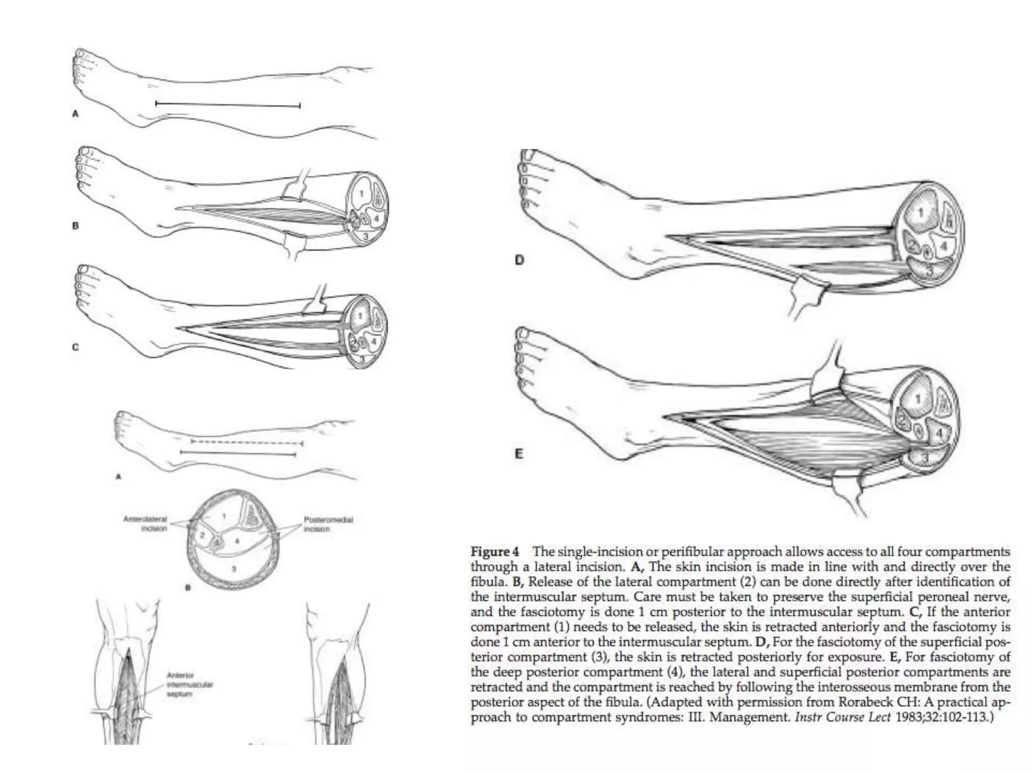 Chronic Exertional Compartment Syndrome (Henry Ford Health System) | PPTX | Death, Injury, or ...