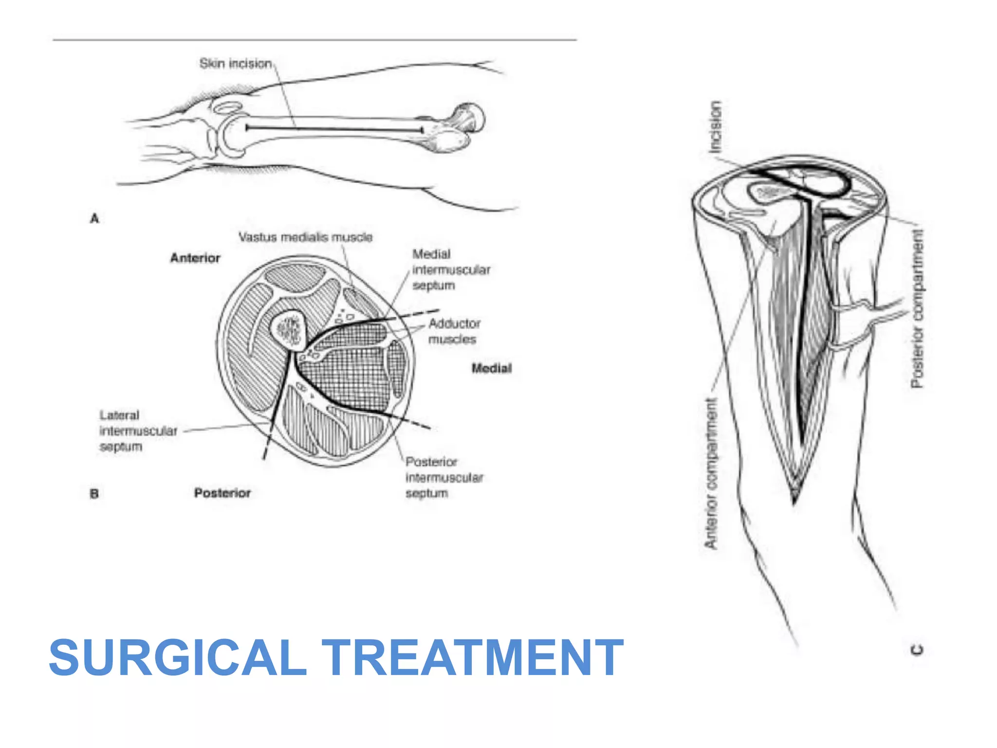 Chronic Exertional Compartment Syndrome (Henry Ford Health System) | PPTX | Death, Injury, or ...