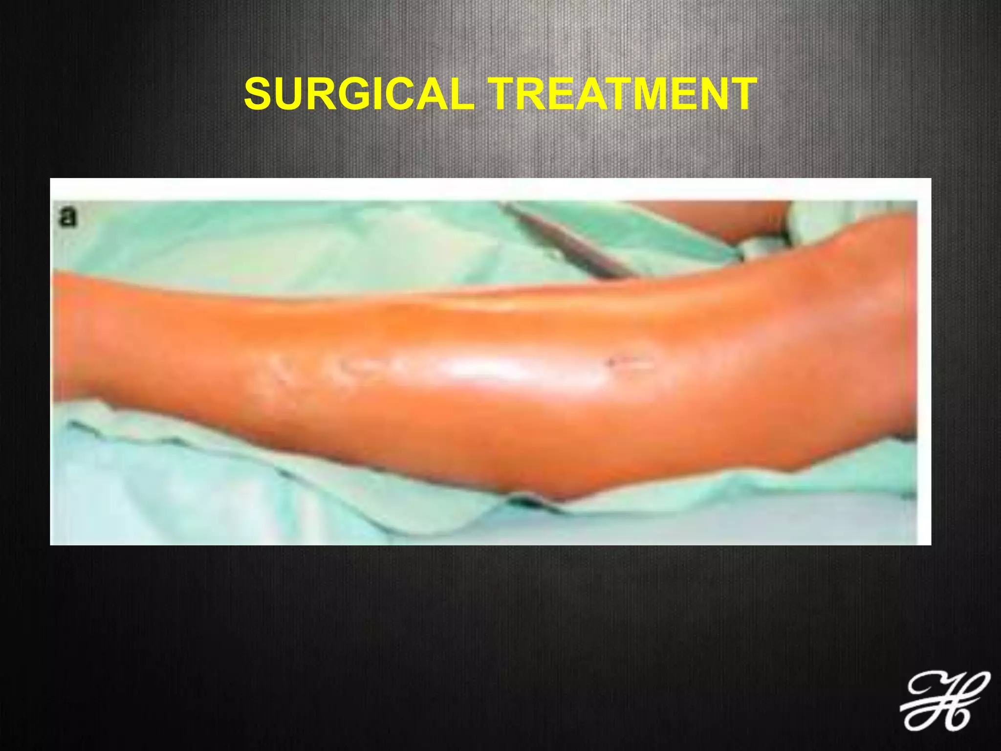 Chronic Exertional Compartment Syndrome (Henry Ford Health System) | PPTX | Death, Injury, or ...