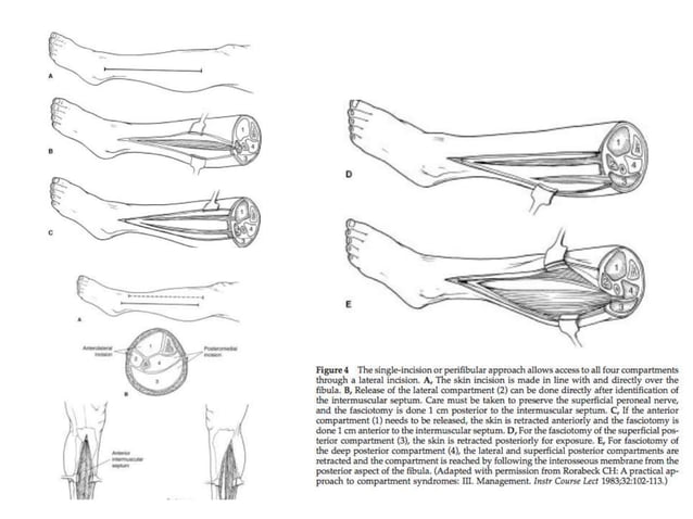 Chronic Exertional Compartment Syndrome (Henry Ford Health System) | PPTX | Death, Injury, or ...