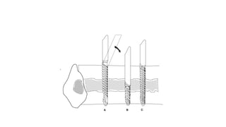 ROLE OF EXTERNAL FIXATOR IN OPEN FRACTURE.pptx
