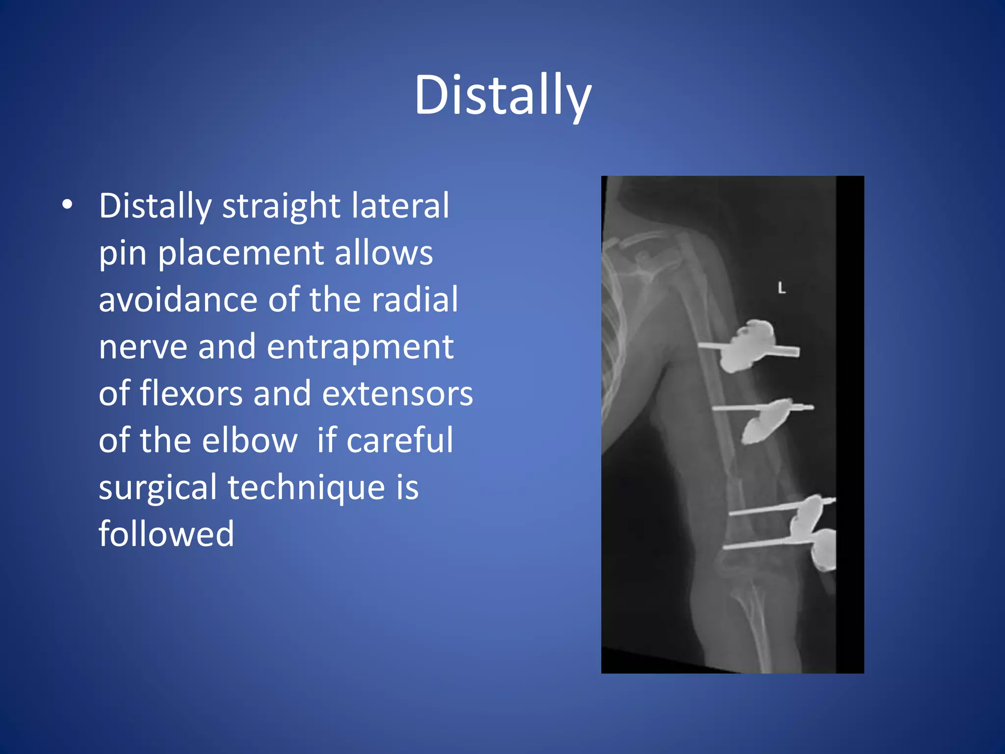 Humerus External Fixation, Avoiding Neuro vascular injury | PPT