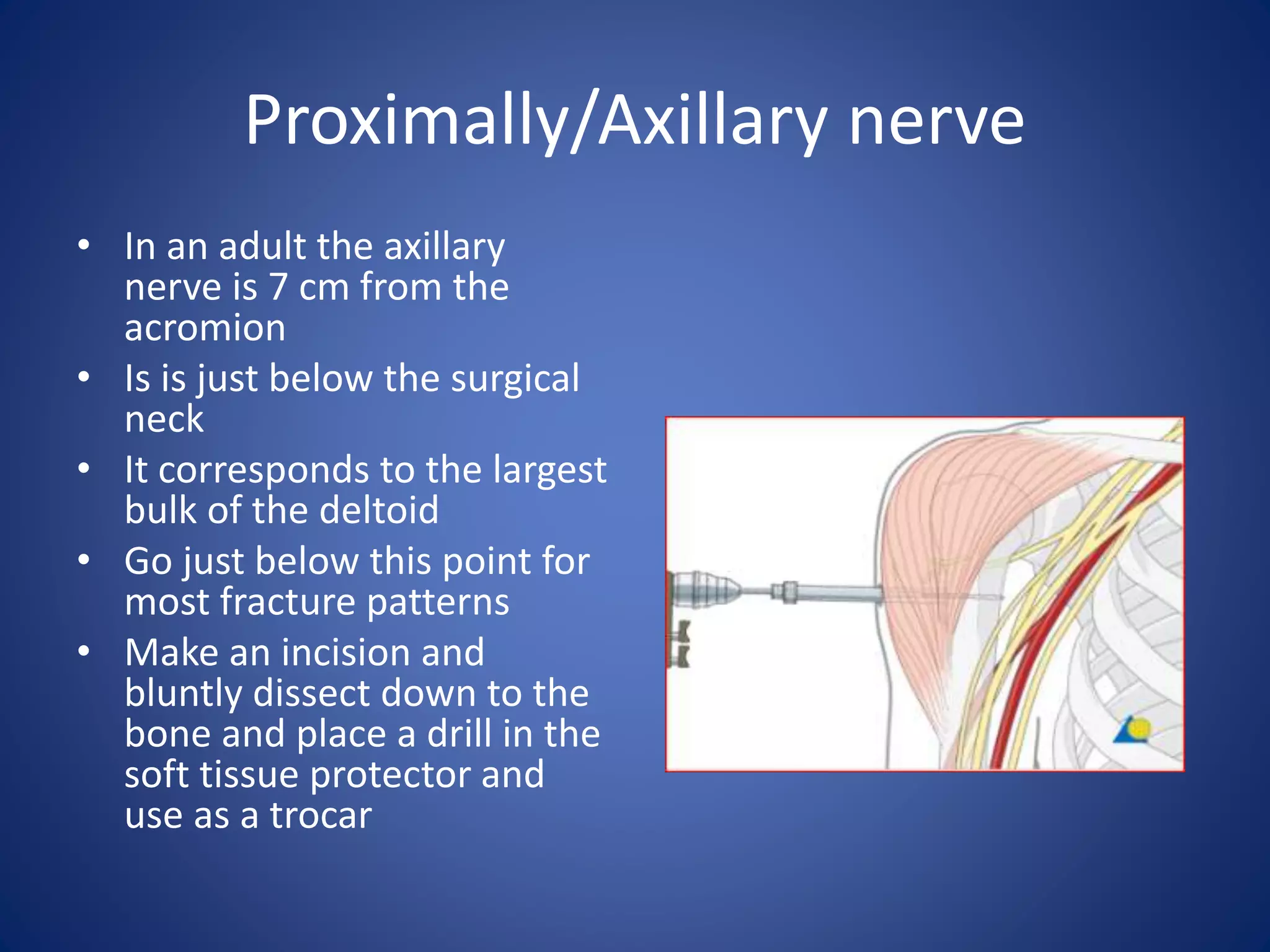 Humerus External Fixation, Avoiding Neuro vascular injury | PPT