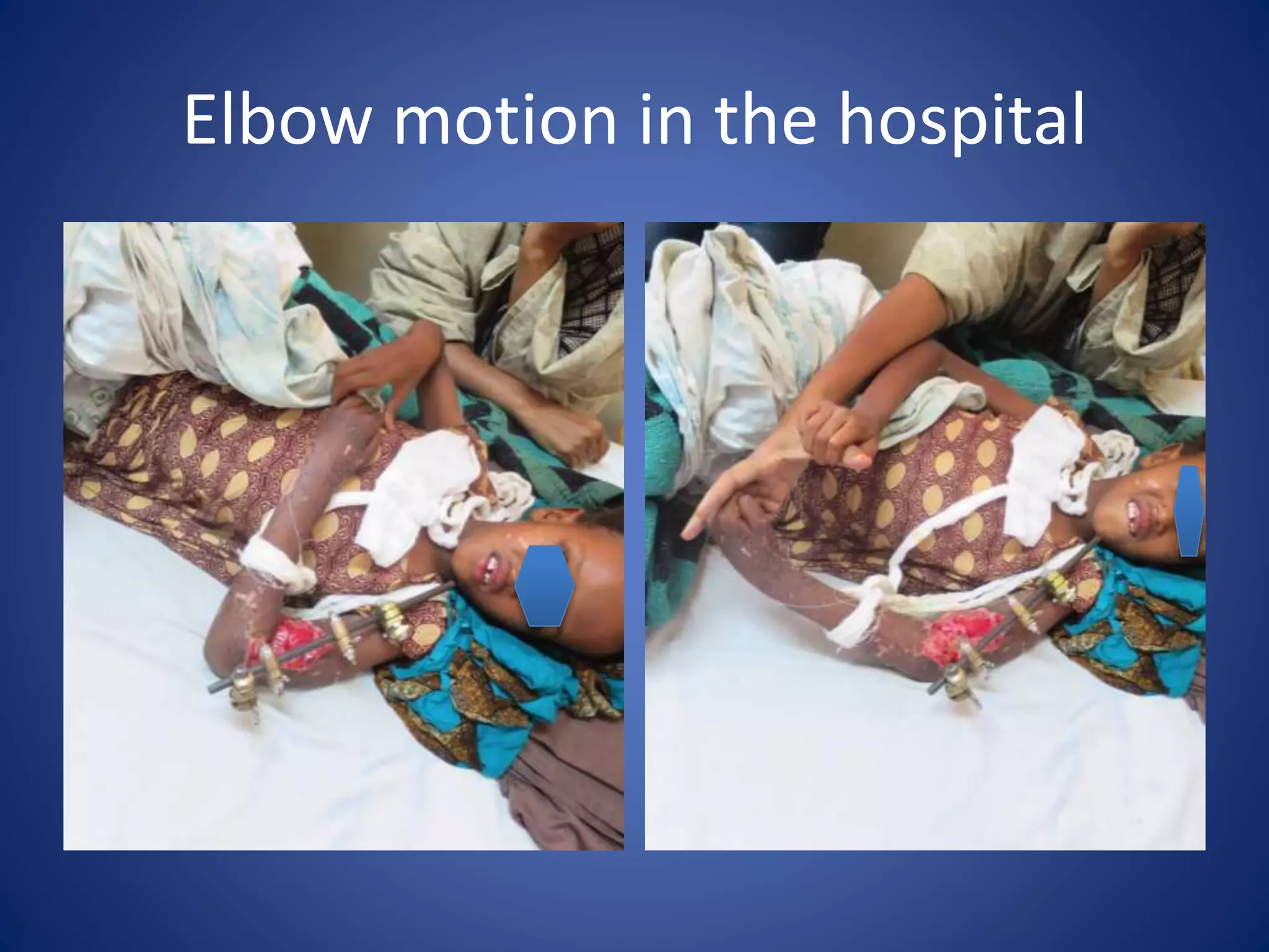 Humerus External Fixation, Avoiding Neuro vascular injury | PPT