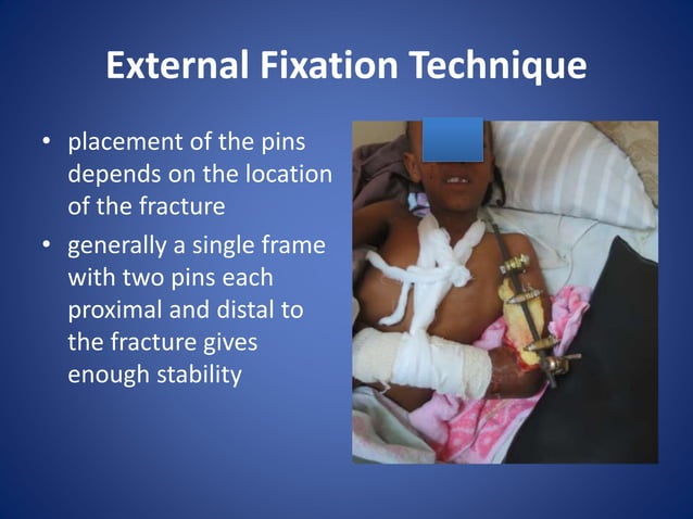 Humerus External Fixation, Avoiding Neuro vascular injury | PPT