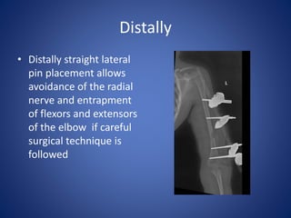 Humerus External Fixation, Avoiding Neuro vascular injury | PPTX