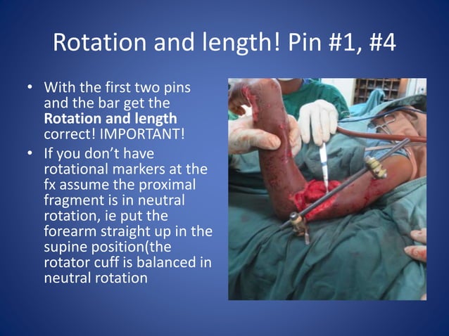 Humerus External Fixation, Avoiding Neuro vascular injury | PPT