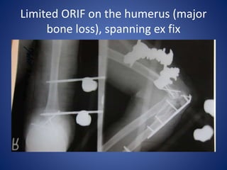 Humerus External Fixation, Avoiding Neuro vascular injury | PPTX