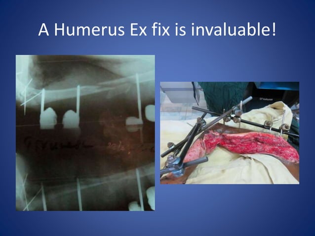 Humerus External Fixation, Avoiding Neuro vascular injury | PPT