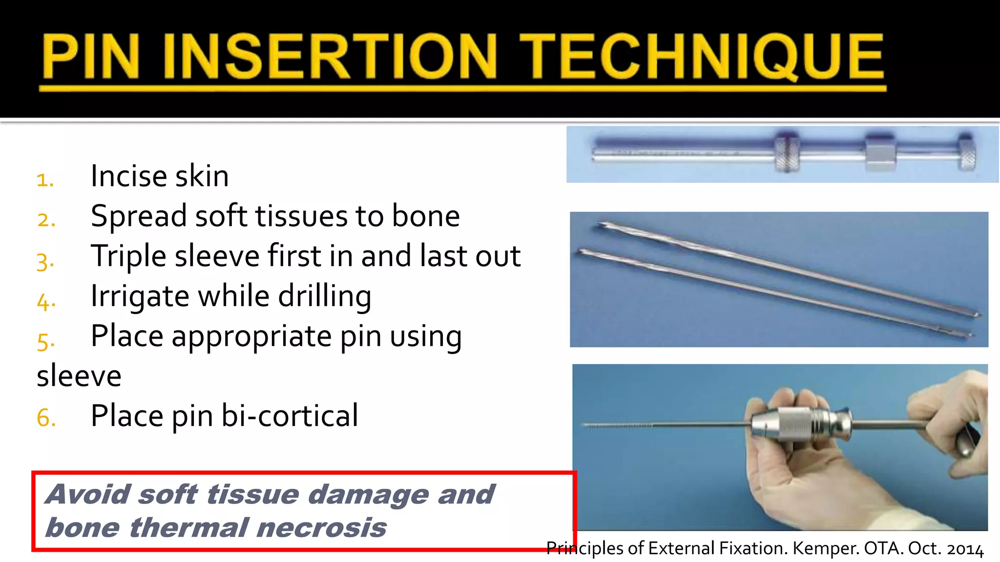 external fixation re | PPTX