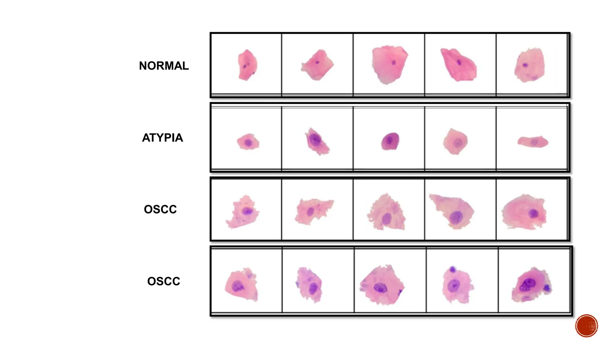 EXFOLIATIVE CYTOLOGY , ORAL CYTOSMEAR, ORAL CYTOLOGY | PPTX