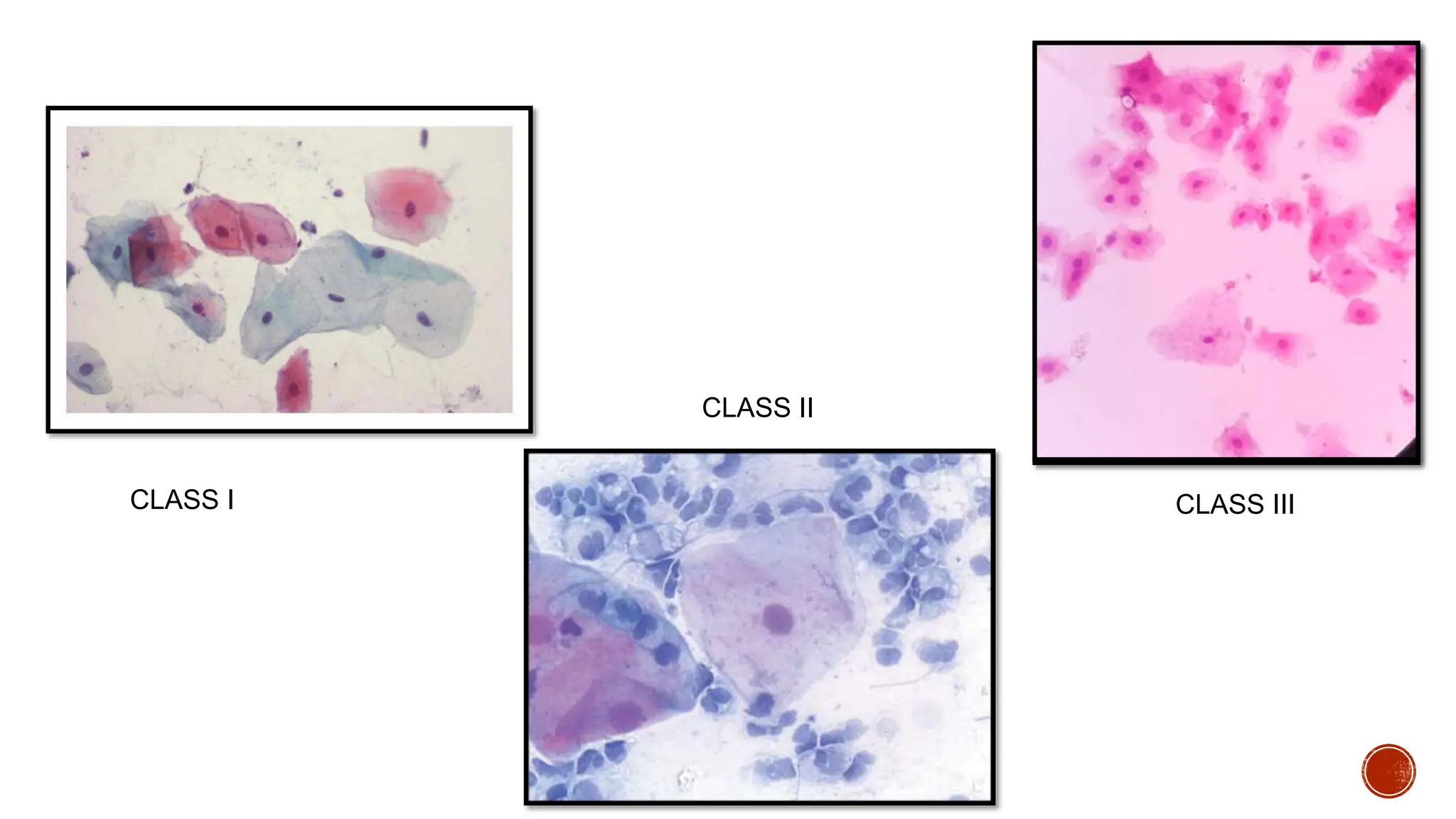EXFOLIATIVE CYTOLOGY , ORAL CYTOSMEAR, ORAL CYTOLOGY | PPTX