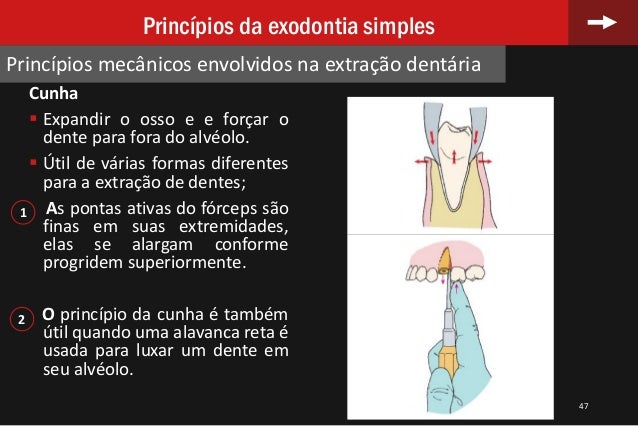 Exodontia simples