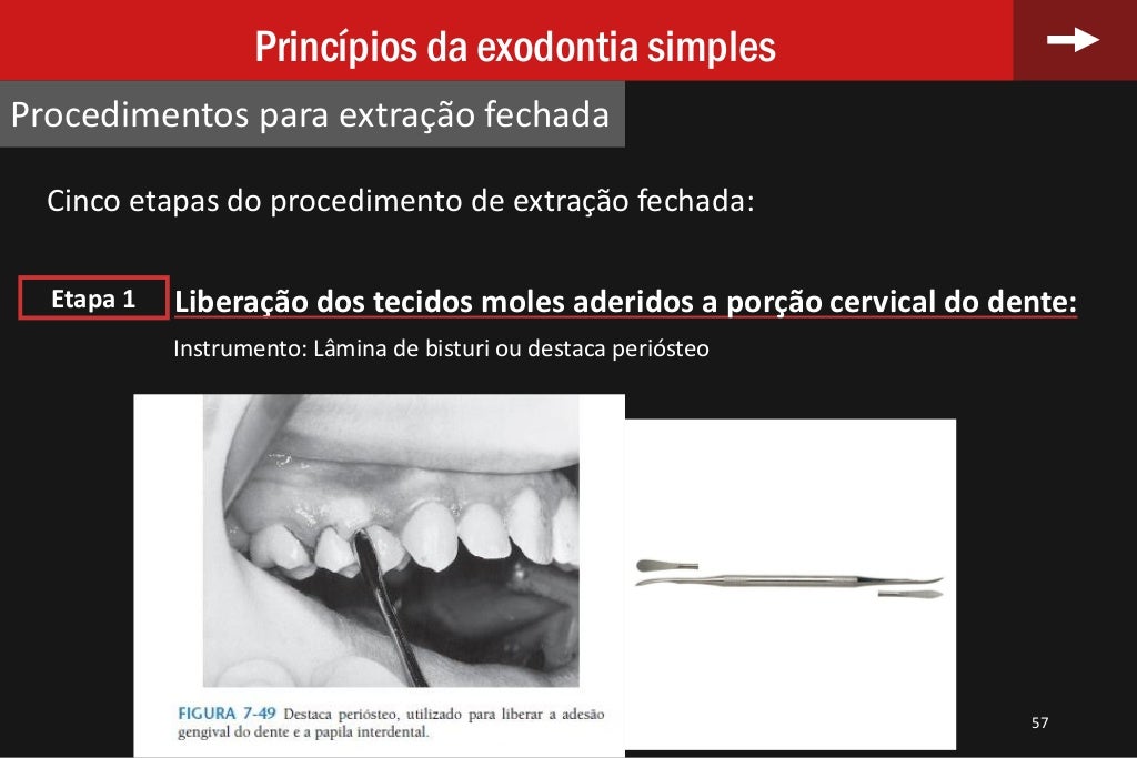Exodontia Simples De Deciduos - RETOEDU