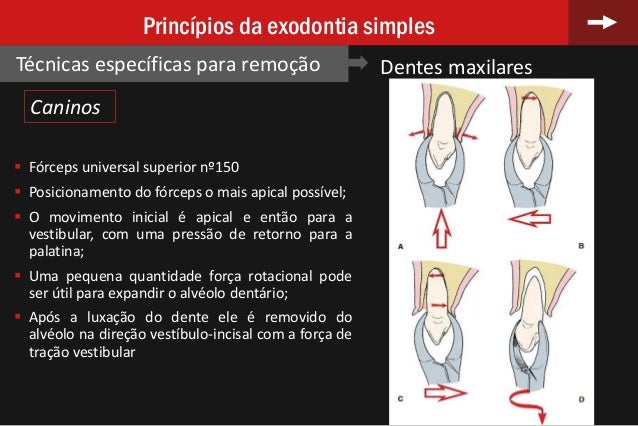 Exodontia simples