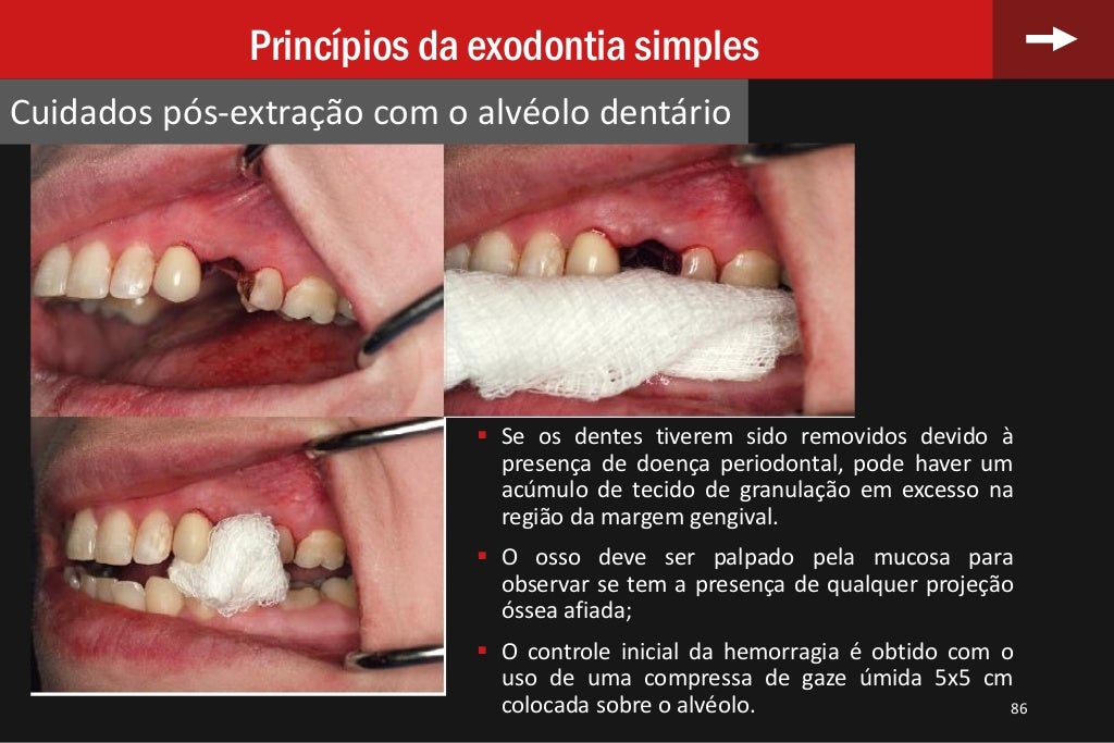 Exodontia Simples De Deciduos - RETOEDU