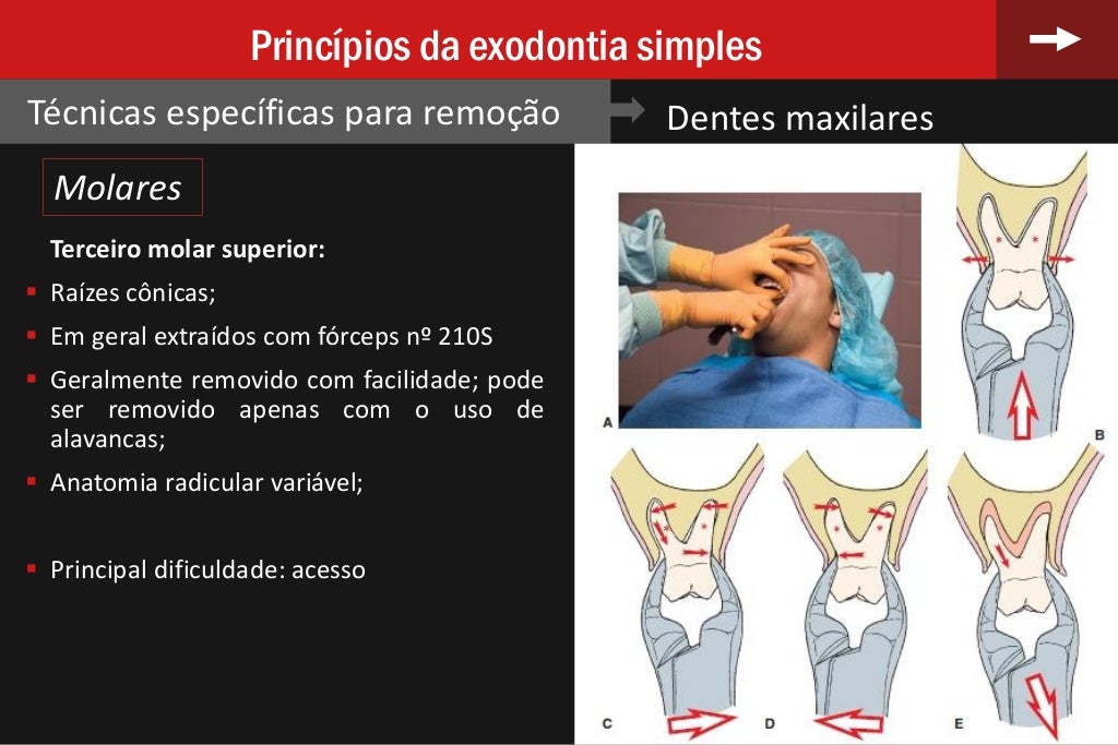 O Que é Exodontia Simples - NAZAEDU
