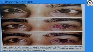 Exo-Deviations | PPTX