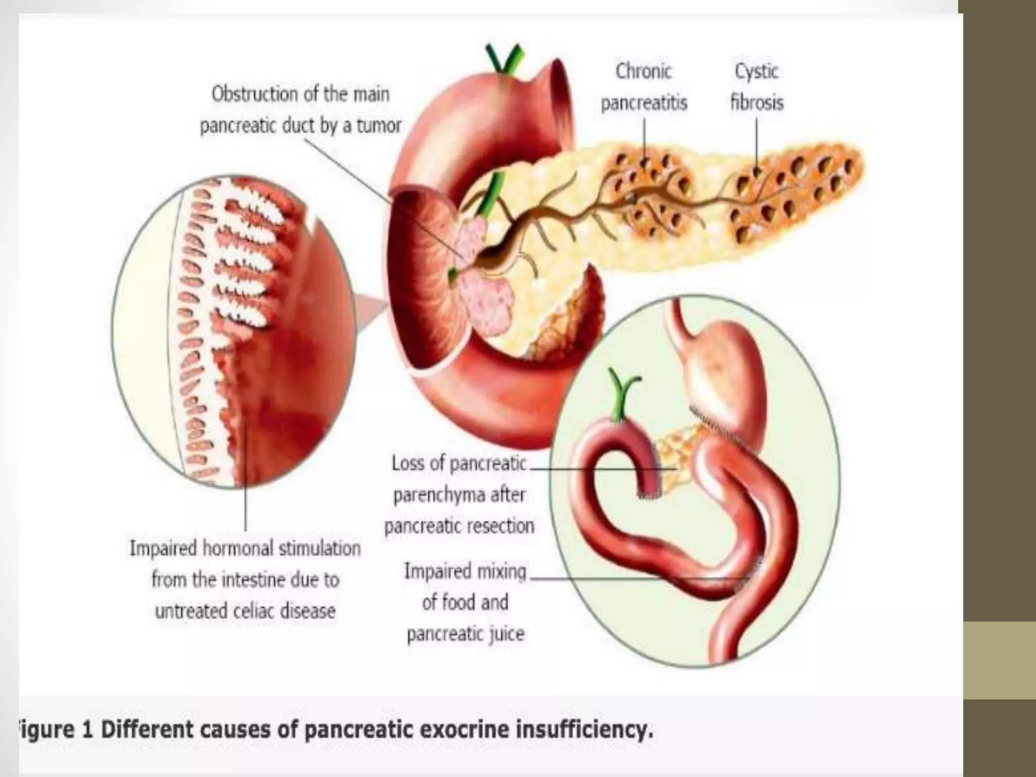 Exocrine pancreatic insufficiency - Dr Shaz Pamangadan | PPTX