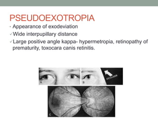 Exodeviations | PPTX