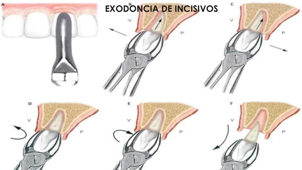 Exodoncia