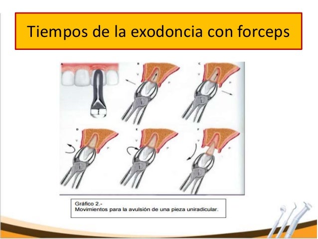 Exodoncia indicaciones, contraindicaciones y generalidades