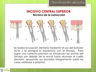 Exodoncia simple | PPTX