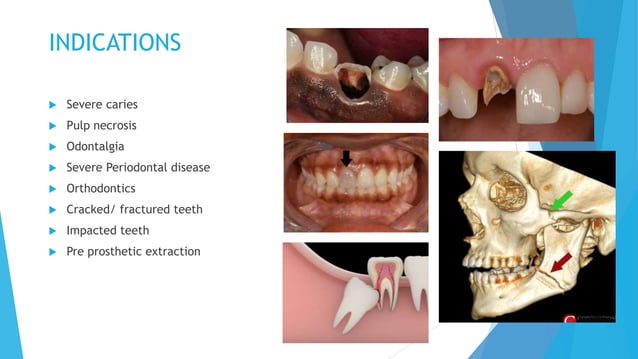 Exodontia | PPT