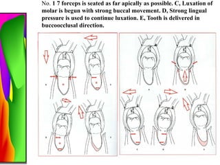 EXODONTIA technique and principles of tooth extraction | PPTX