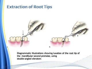 exodontia-principles-techniques-and-complications.pptx