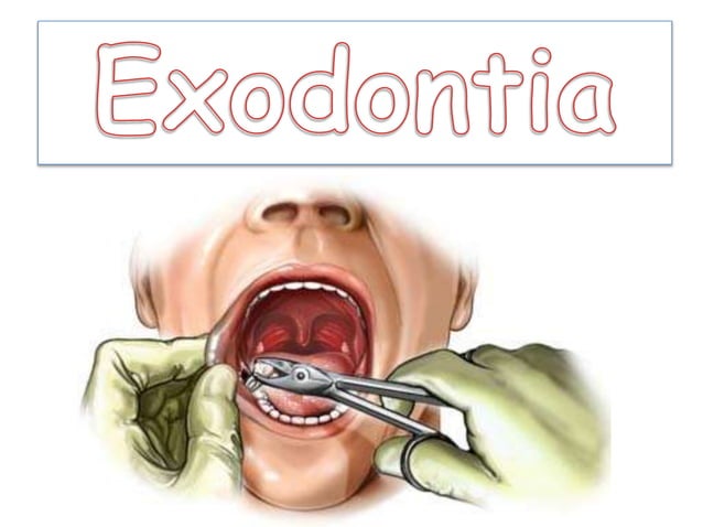 Exodontia | PPTX