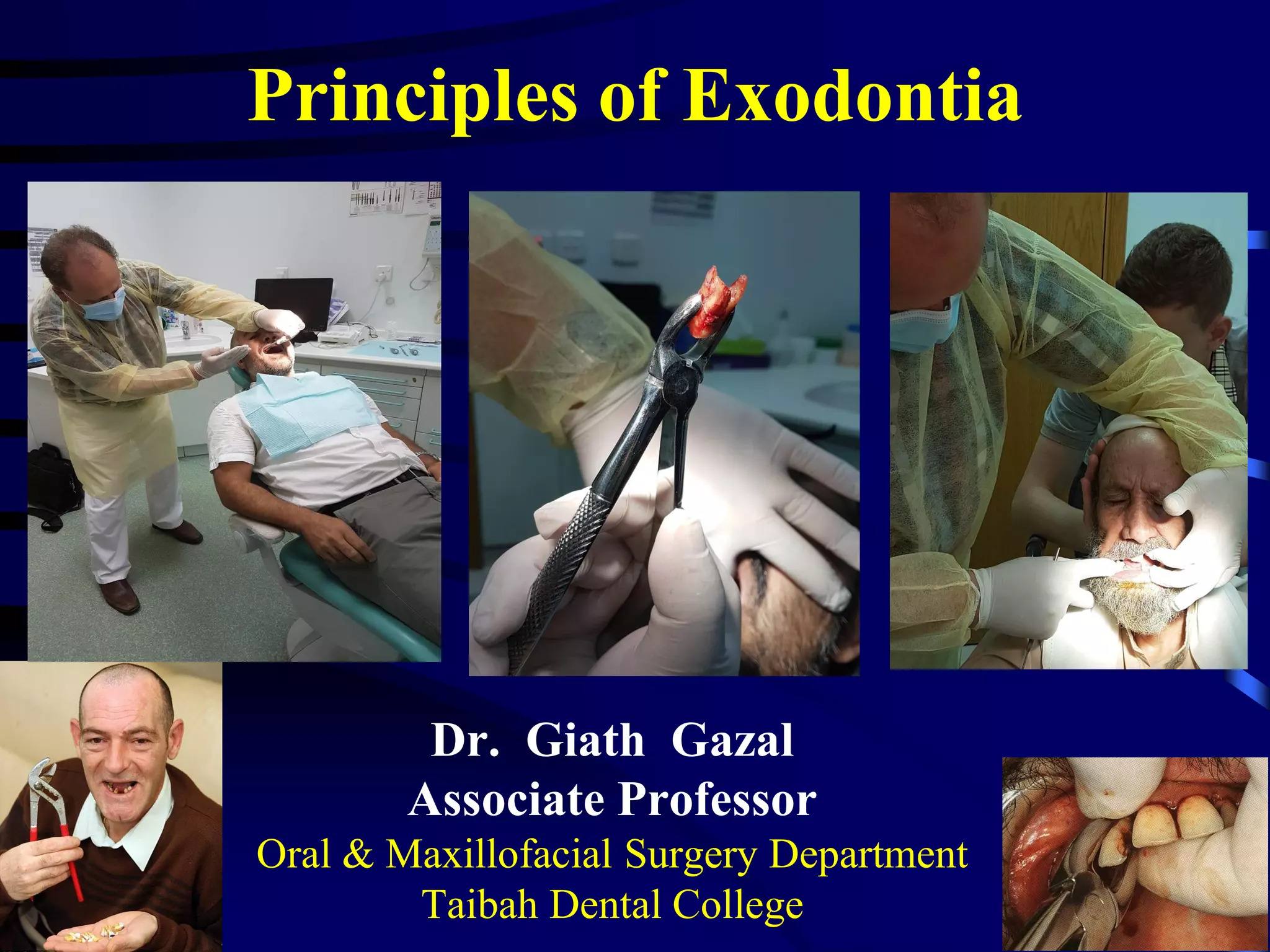 Principles of Exodontia (teeth extraction) by Dr., Giath Gazal, 2020 | PPT